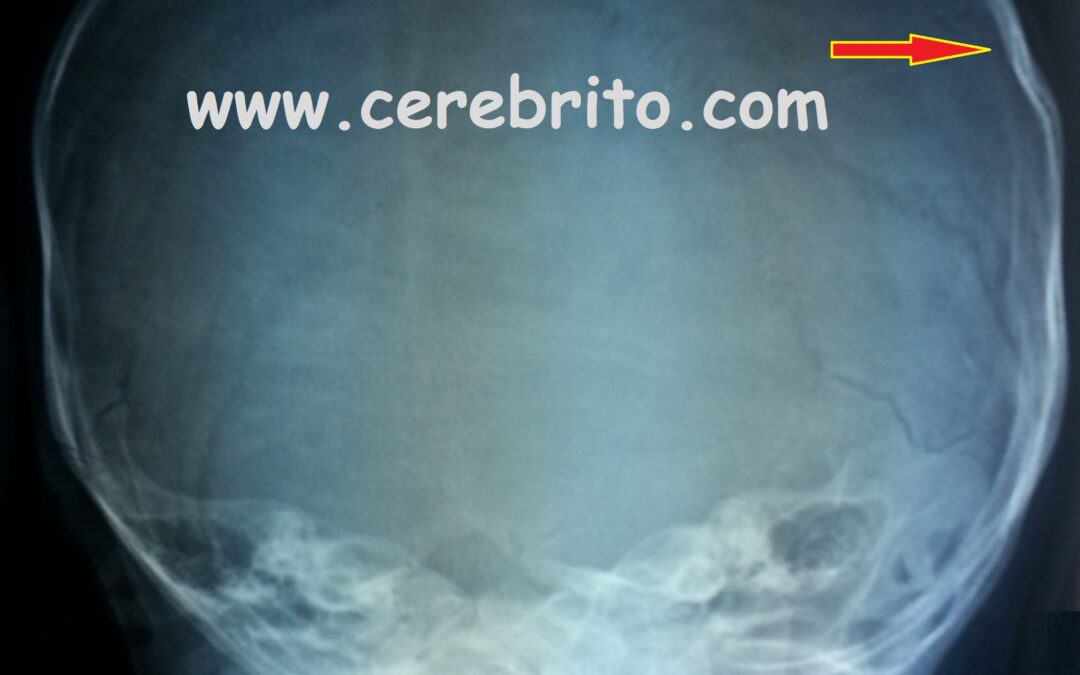 fractura craneo ping pong-1 - Neuropediatra, Neurólogo Pediatra ...