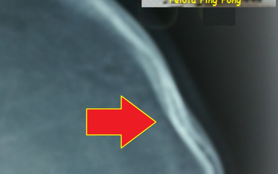 fractura de Craneo en Ping-Pong - Neuropediatra, Neurólogo Pediatra ...