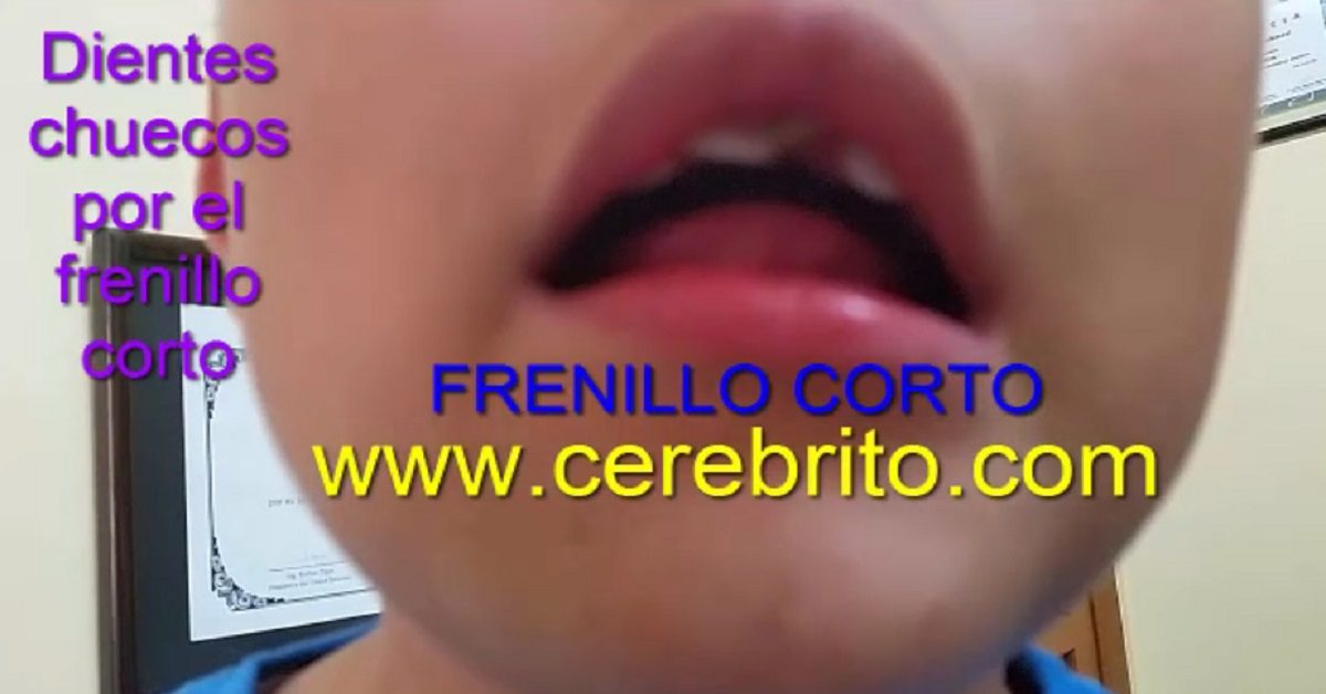 Frenillo Corto - ACADEMIA CEREBRITO